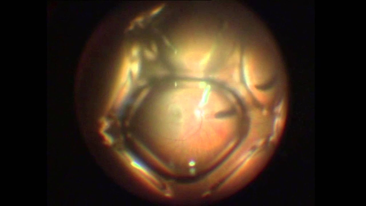 Chirurgie du trou maculaire - Macular hole surgery - YouTube