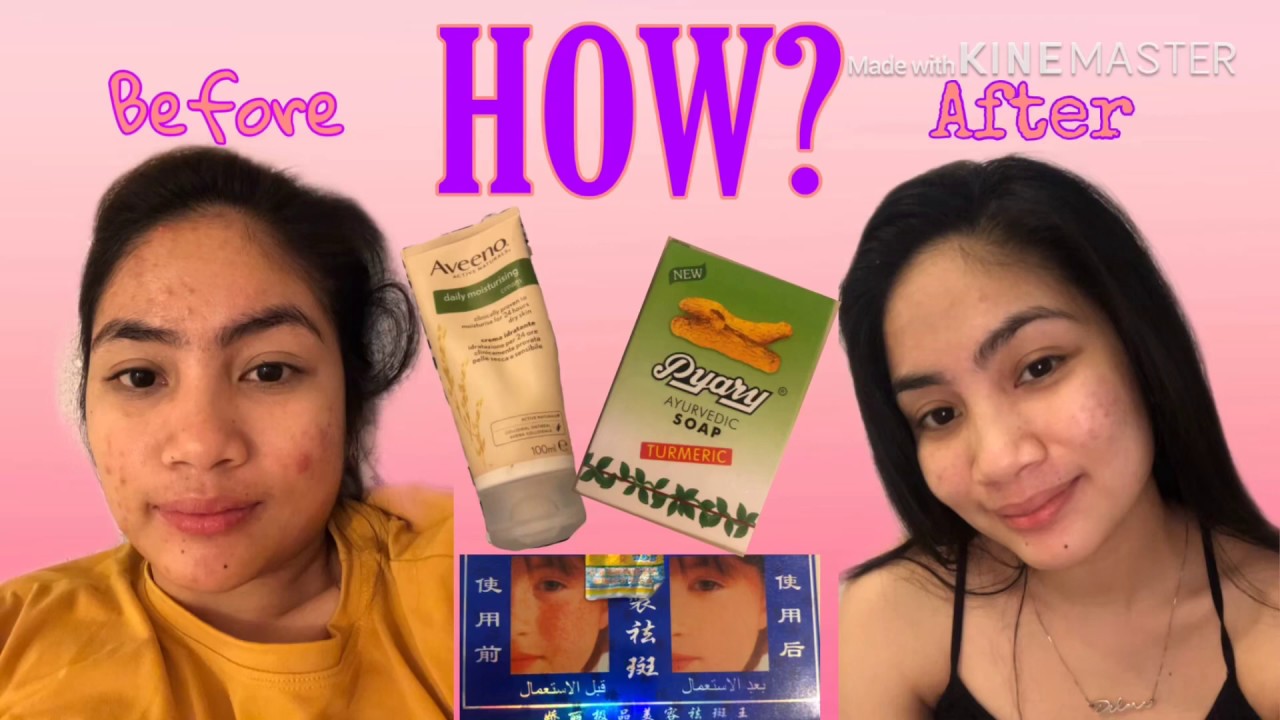 ACTIVE PIMPLES TO PIMPLE MARKS | VLOG #2 - YouTube