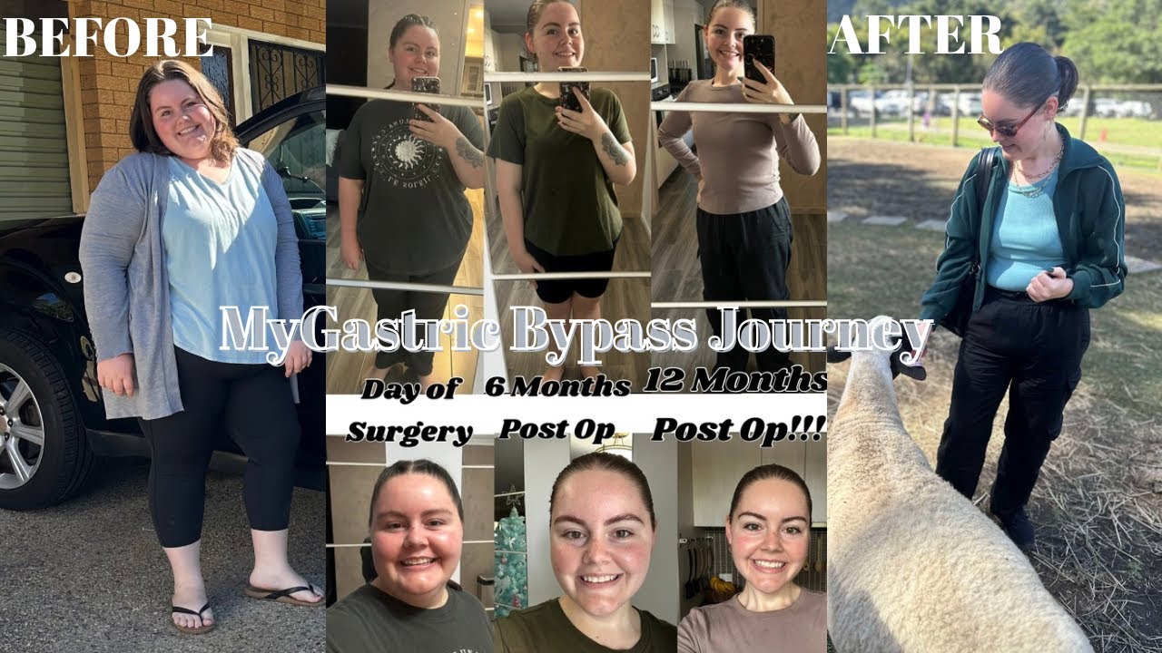 My Gastric Bypass Journey | How has it been?! | 12 Month Post Op Chat ...
