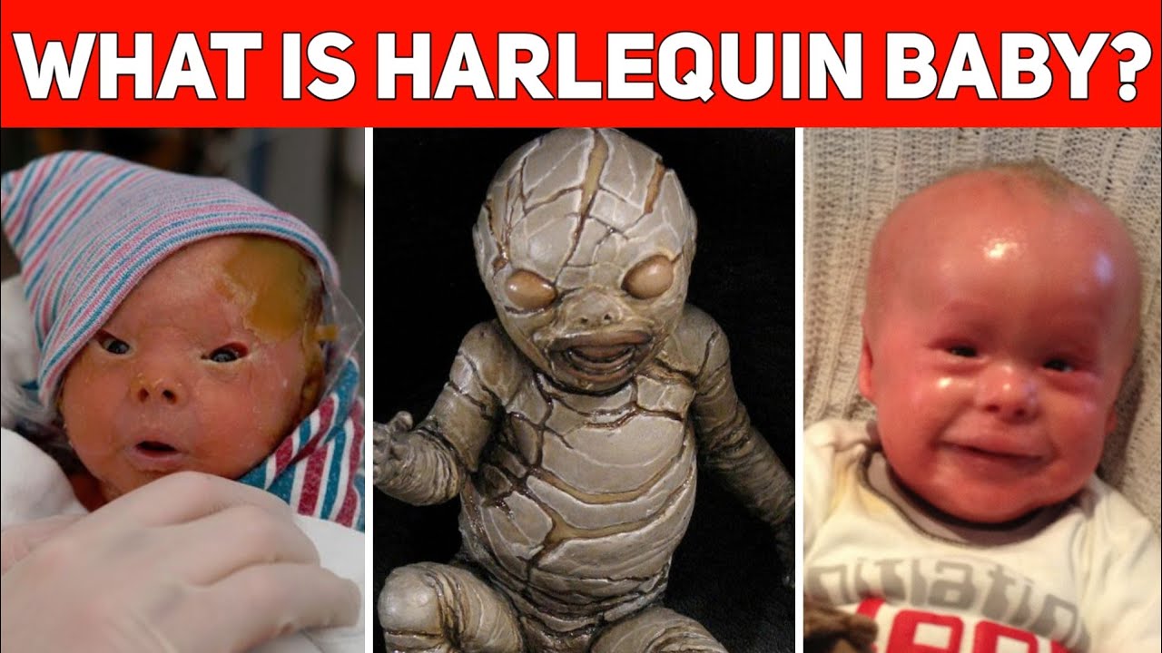 What is Harlequin Ichthyosis? | World’s Saddest Skin Disease - YouTube