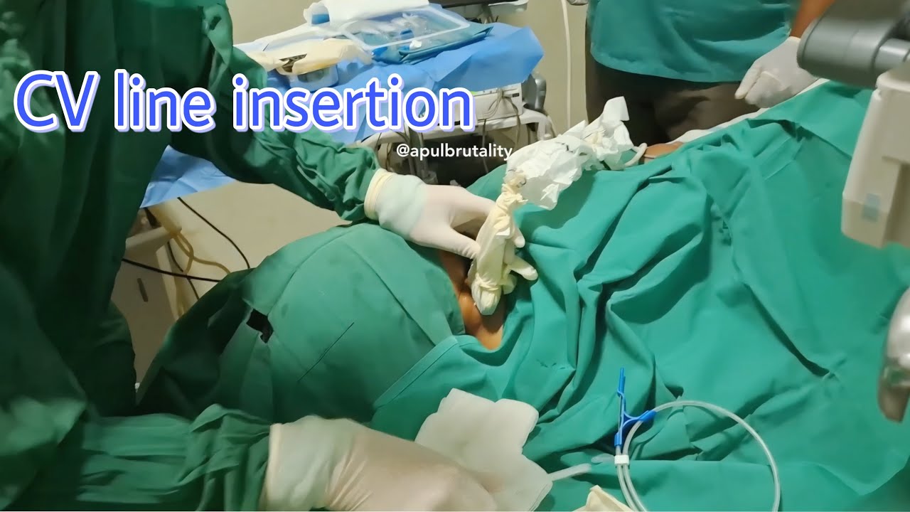 Central venous line insertion - CVC jugularis - ultrasound guided - YouTube