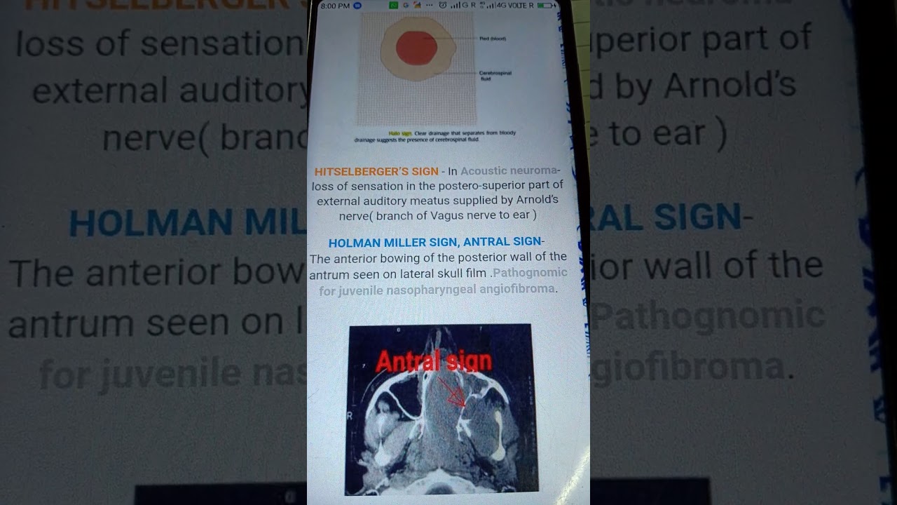 Hitselberger sign - YouTube