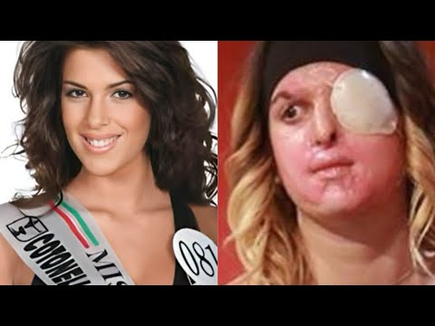 La BELLA MODELO ITALIANA DESFlGURADA por su EXNOVIO: La historia de Gessica Notaro - UHR 👁️