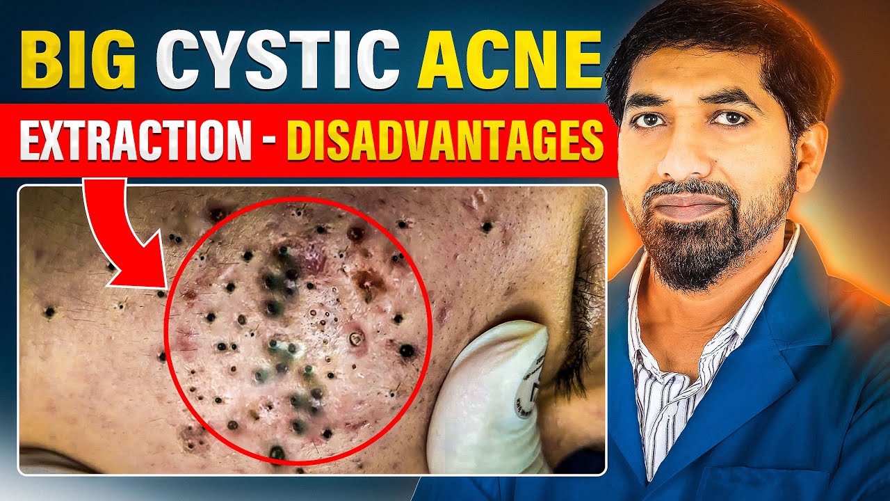 The Shocking Truth About Cystic Acne Extraction Side Effects Revealed ...