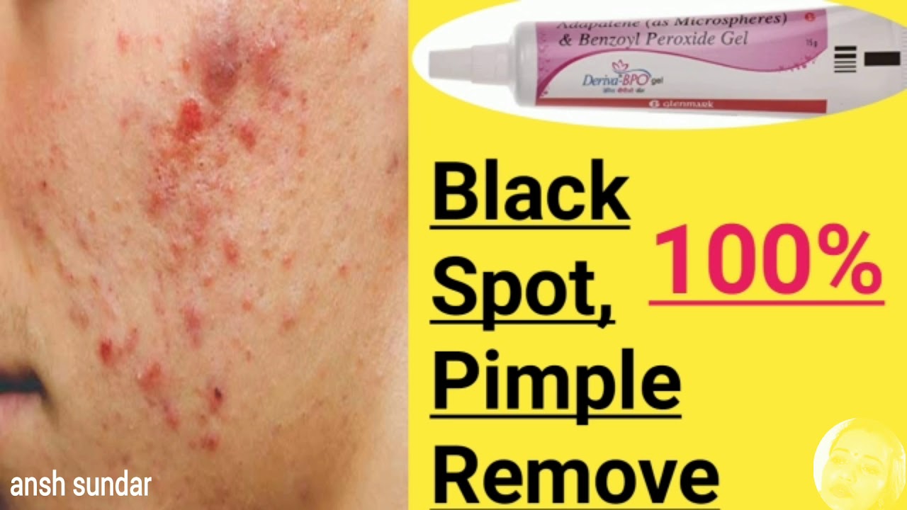 deriva bpo gel review | benzoyl peroxide gel 2.5 | bpo gel honest ...