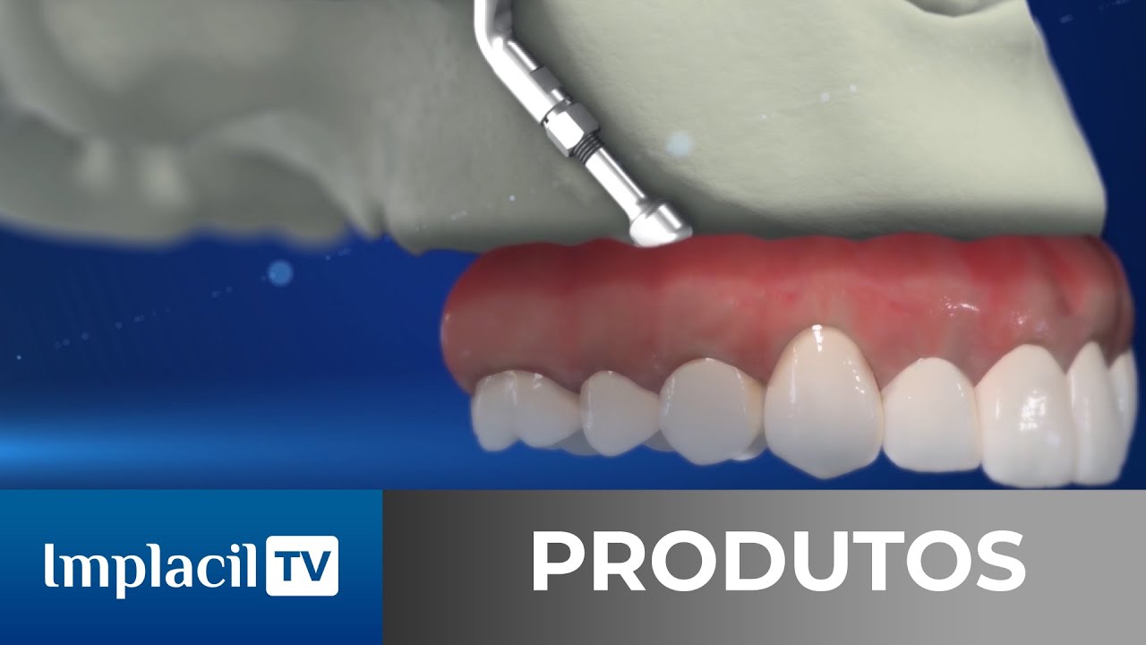 Pilar Z - Implante convencional osso zigomático, nova abordagem para ...