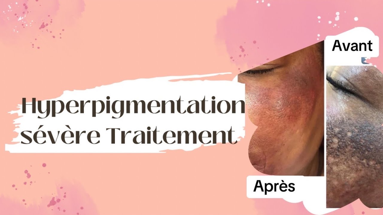 Vidéo 2 Comment reconnaître l’ochronose sur la peau Noire ? - YouTube