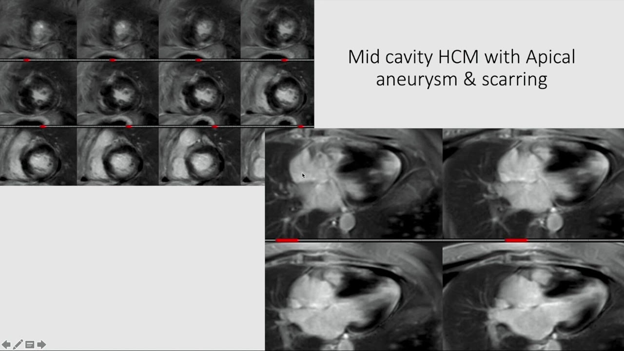 15. HCM Case Based Assessment with CMR Dr Vishnu Ravilla - YouTube