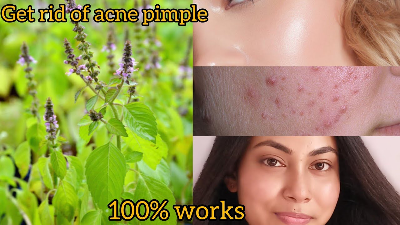 How to get rid of acne pimple within 1week? magical treatment/DIY/One ...