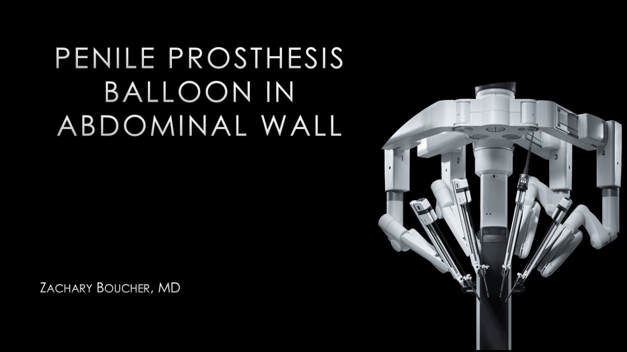 Penile Prosthesis Balloon Causing Abdominal Wall Pain - YouTube