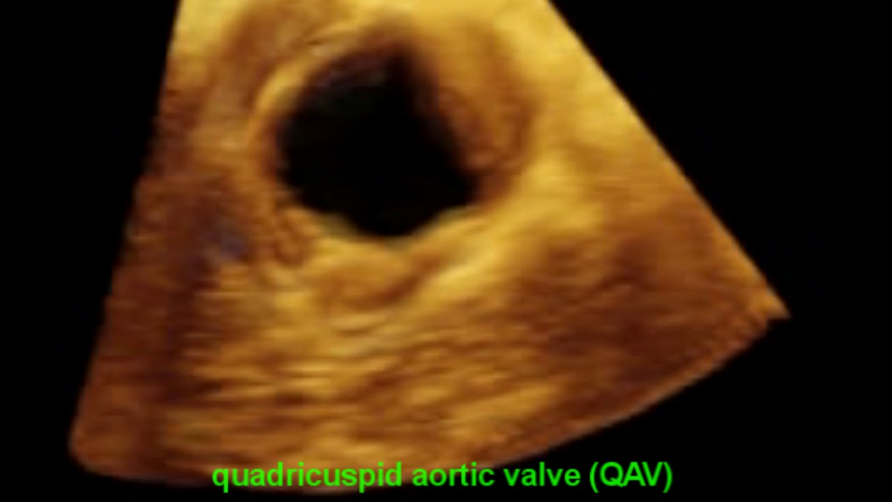 Quadricuspid aortic valve QAV - YouTube