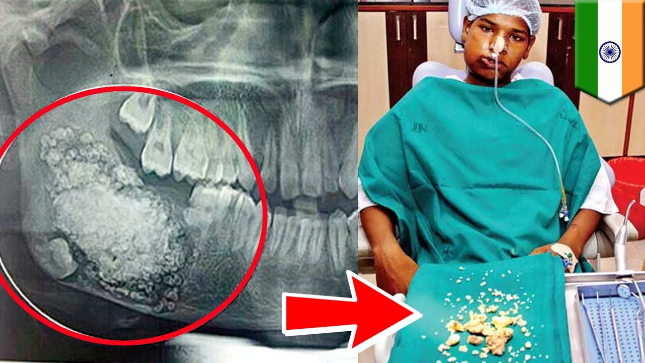 Dentyści usuwają chłopcu 232 zęby. - YouTube