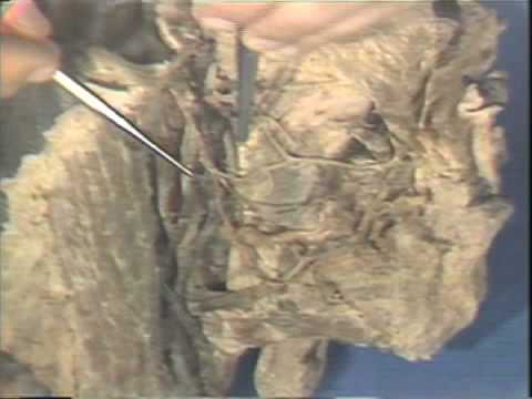 Dissection: Lateral Aspect of Face; Facial Nerve - YouTube