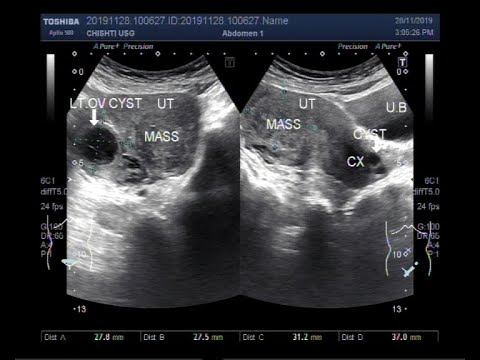 Ultrasound Video showing the focusing of Uterine mass, ovarian cyst ...