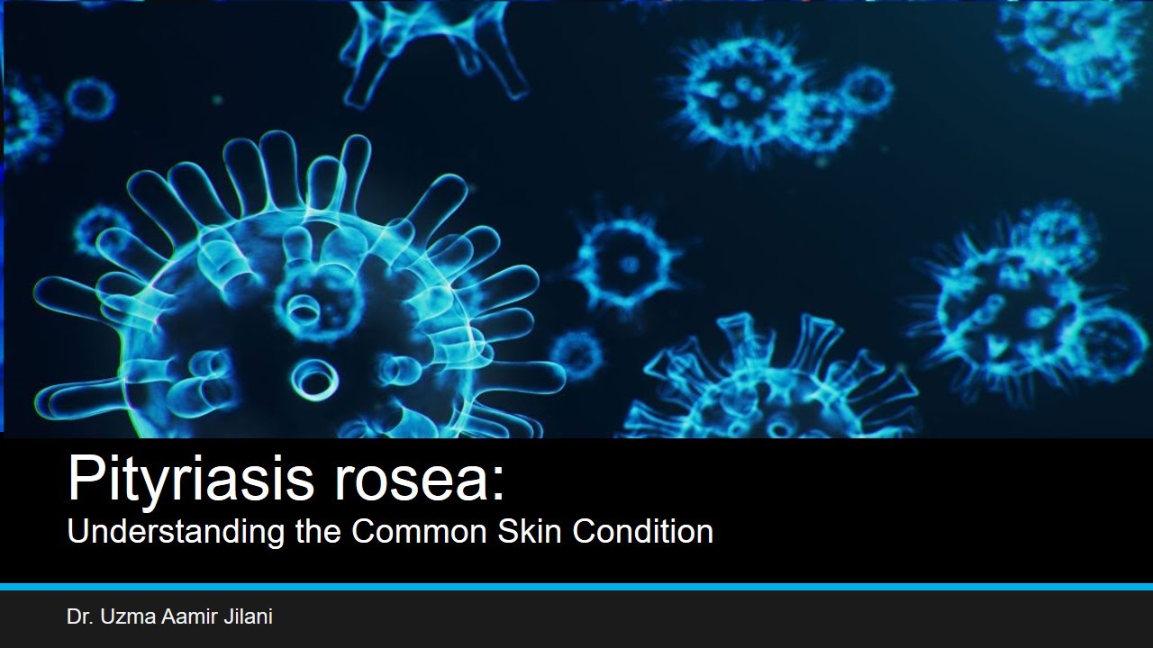 Pityriasis Rosea Overview: Common Symptoms, Diagnosis, and Treatment ...