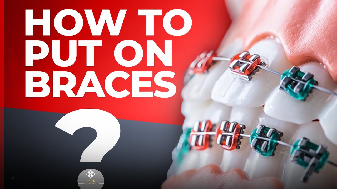 🤍 How to Put on Braces? - Lema Dental Clinic - YouTube
