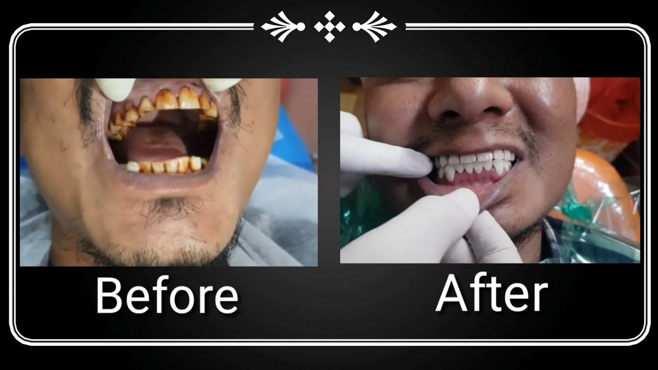 Transforming the patient Smile to confident again.. 20 Teeth complete ...