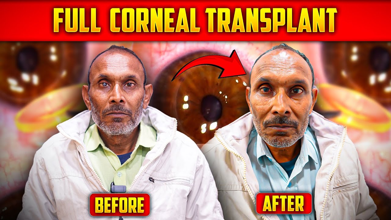 Live Corneal Transplant Surgery | Real Patient Experience - YouTube