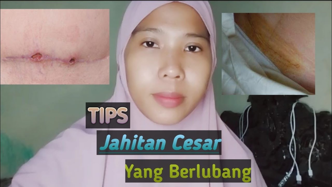 CARA MERAWAT SENDIRI LUKA OPERASI CESAR YANG BOLONG | PENGALAMAN ...