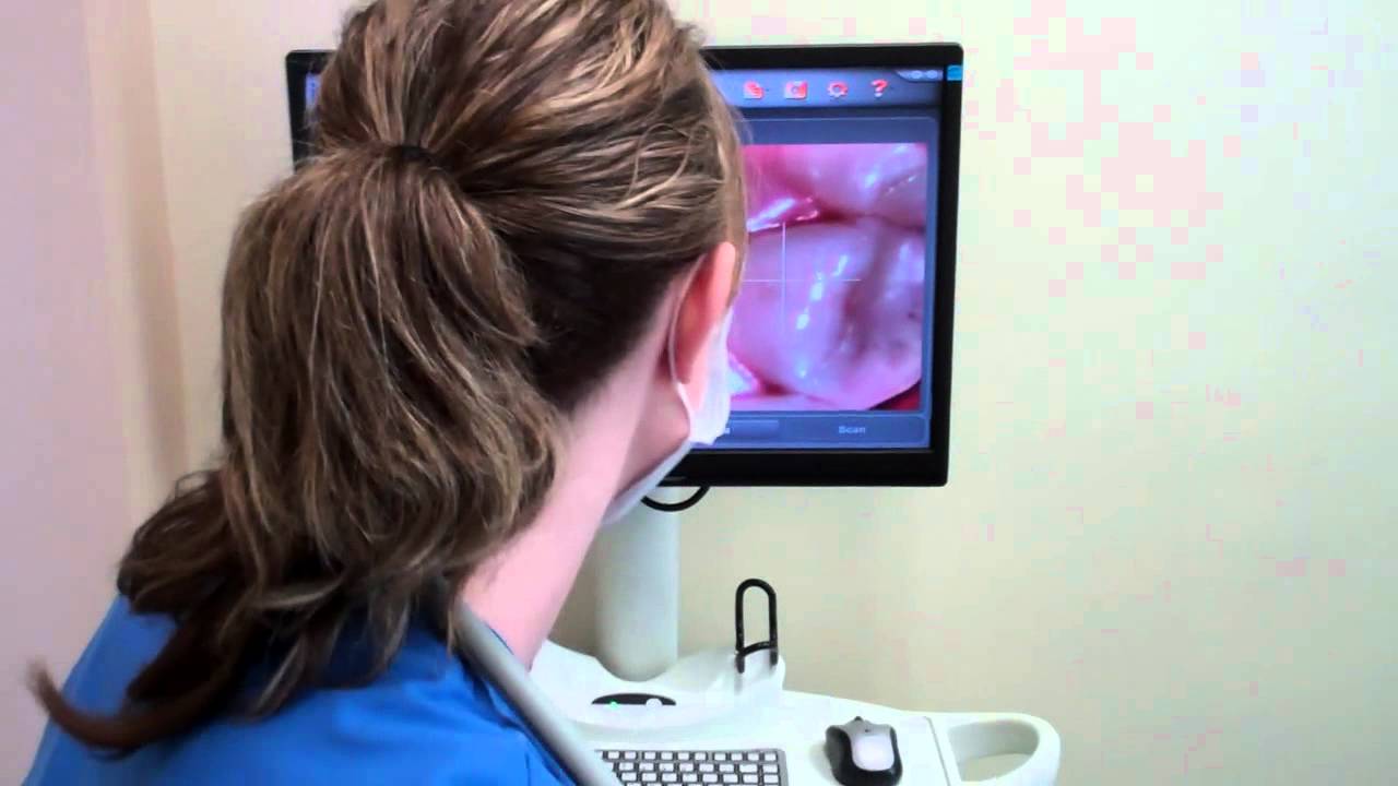 New Invisalign Laser Scanning - YouTube