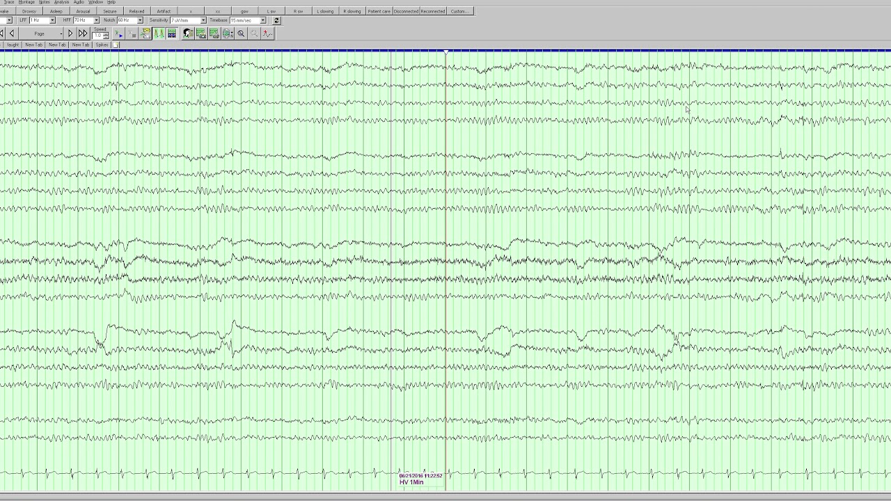 Left parasagittal epileptiform activity - YouTube