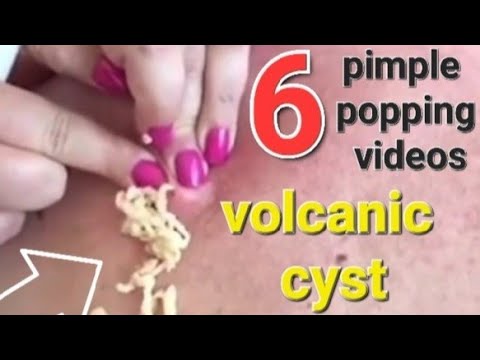 PIMPLE popping video//MUST watch//Sebaceous CYST #pimplepopping # ...