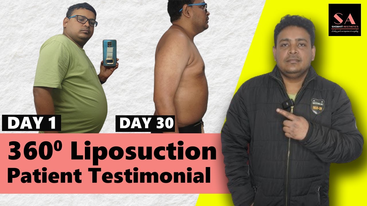 360° Liposuction Patient Testimonial | No More Belly Fat After 30 Days ...