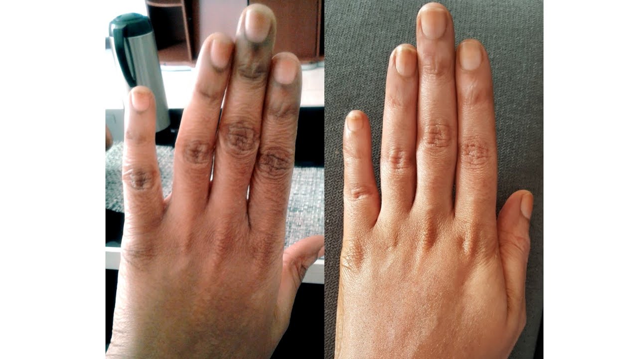 PART 1. 3DAY DARK KNUCKLES TREATMENT PART 1 - YouTube
