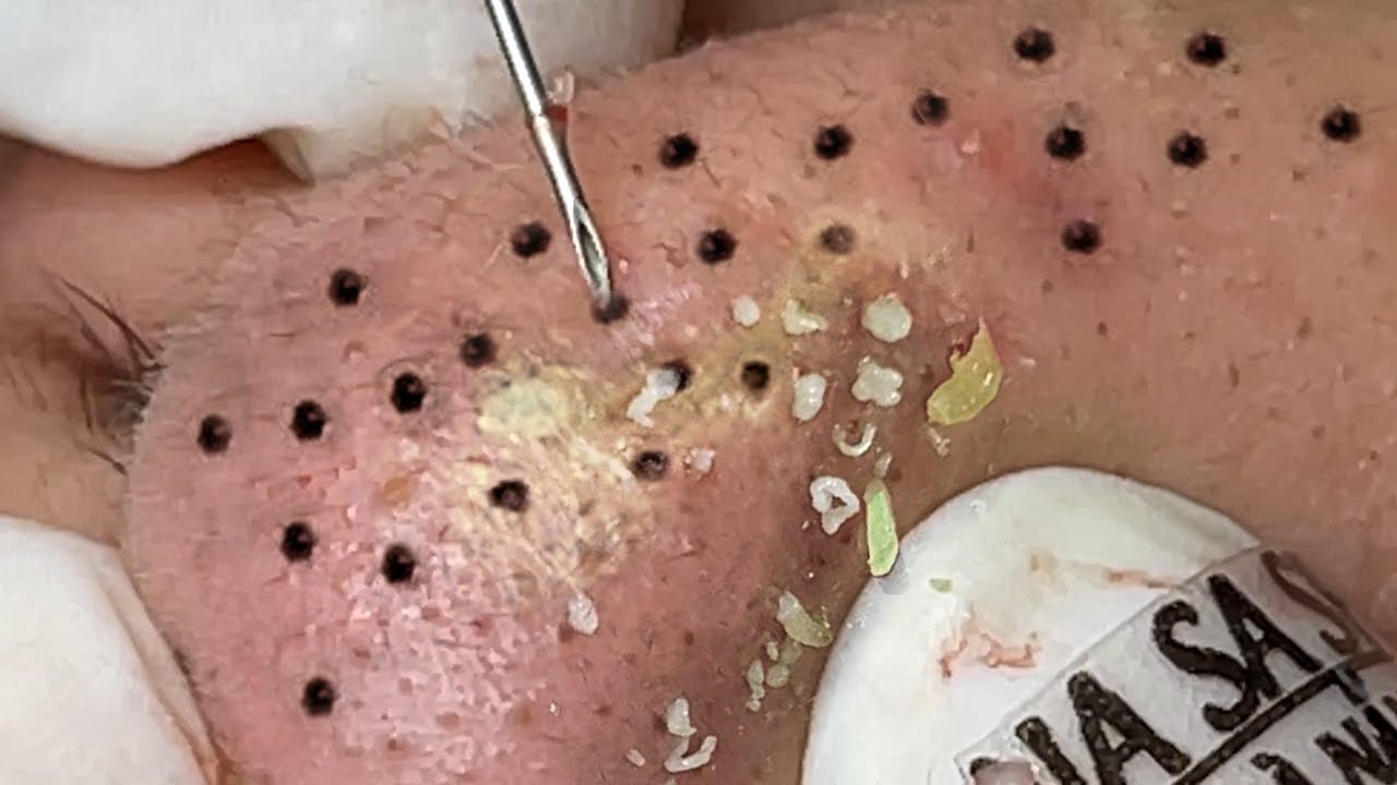 Blackhead Removal With Sac Dep Spa @100074614 - YouTube