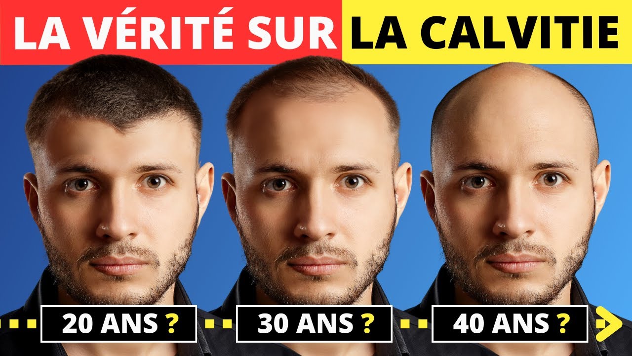 Pourquoi et comment vos cheveux tombent 😱 - La vérité sur la calvitie ...