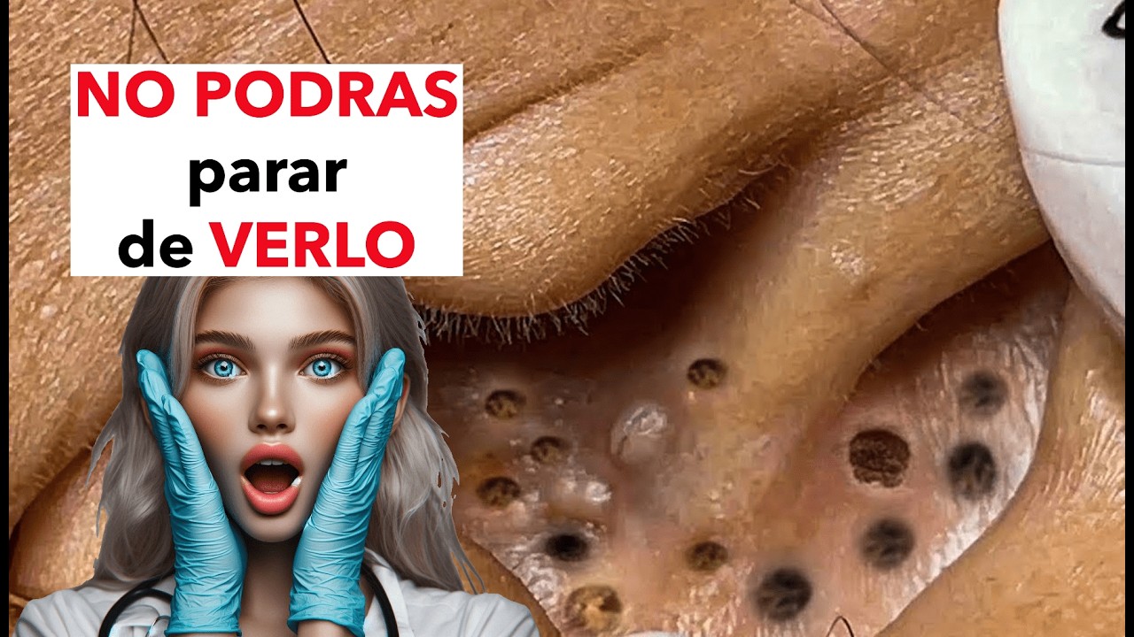 10 RAZONES por los que AMAS la extracción de ESPINILLAS - YouTube