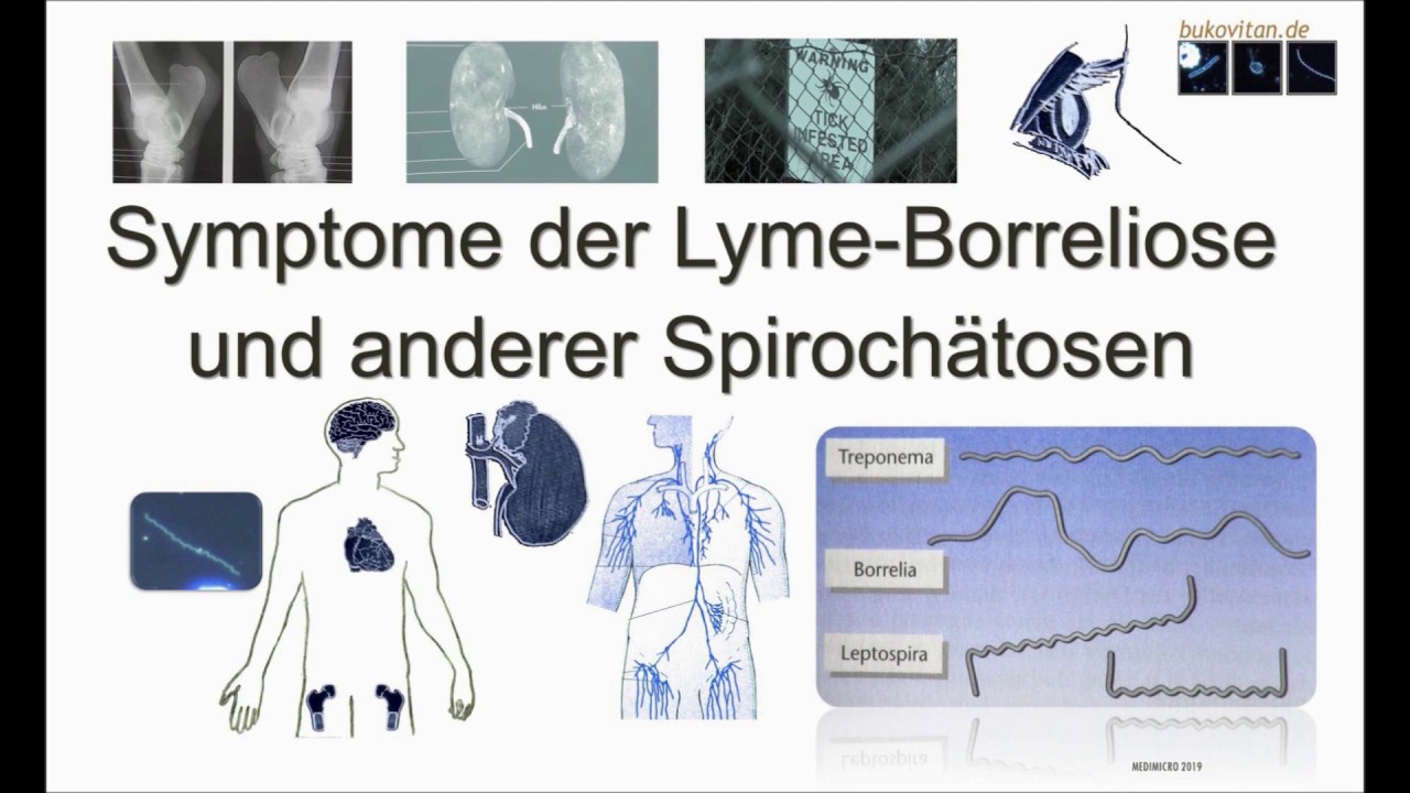 Symptome der Lyme-Borreliose und anderer Spirochätosen / Ganzer Film ...
