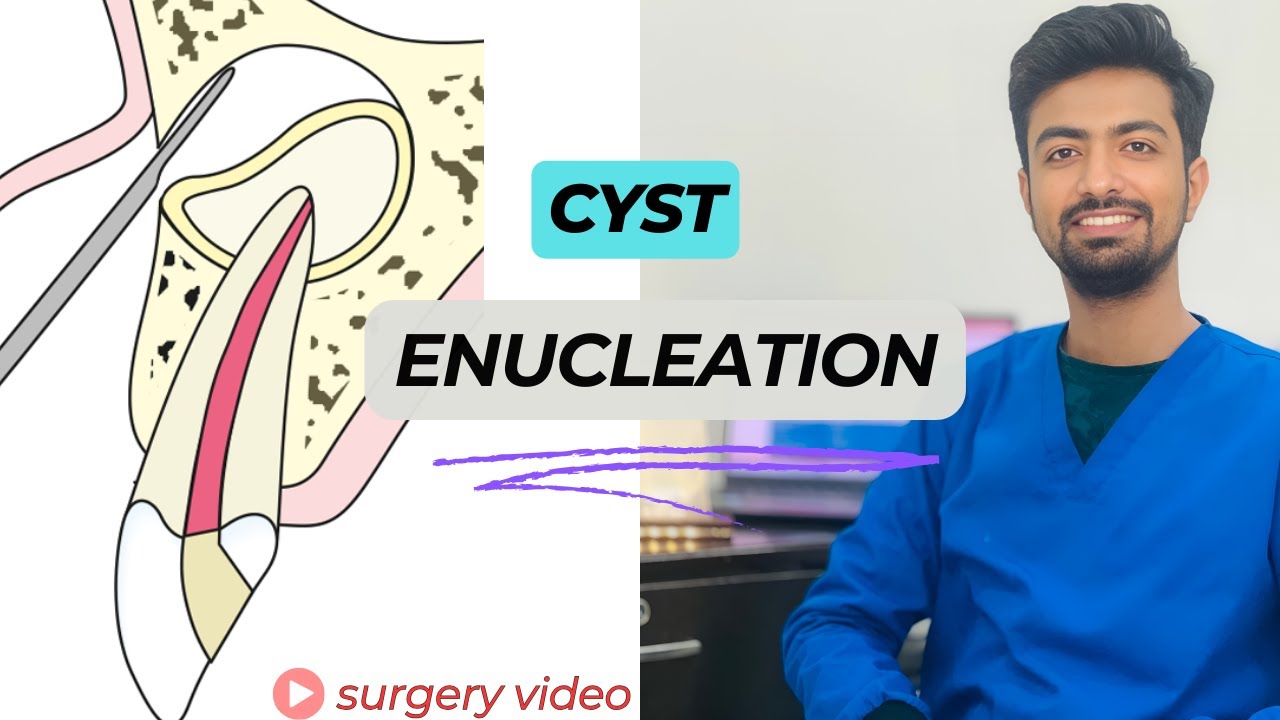 Cyst Removal || Enucleation || Surgical Video || Oral surgery ...