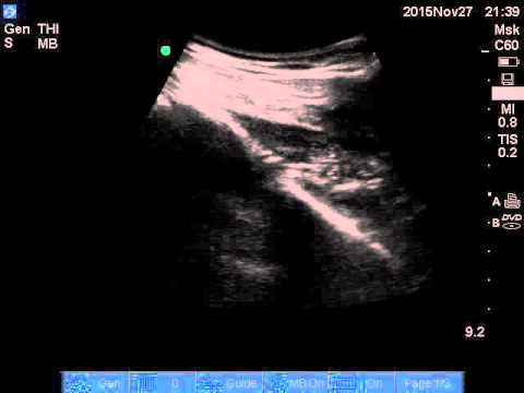 Ultrasound guided parasacral sciatic nerve block - YouTube