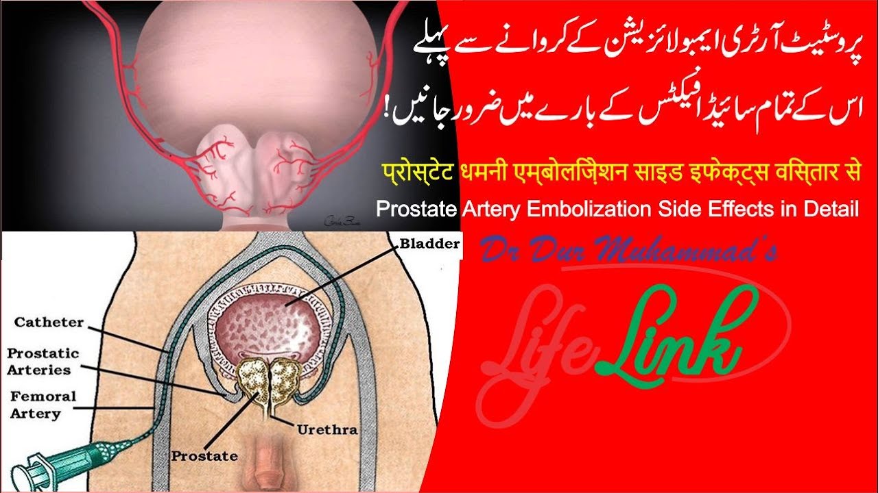 Prostate Artery Embolization Side Effects in Detail - YouTube