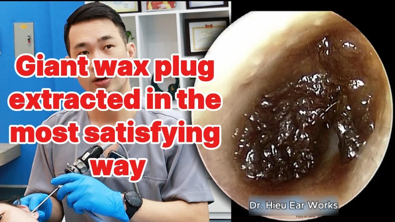 Giant wax plug extracted in the most satisfying wa | ear cleaning ...