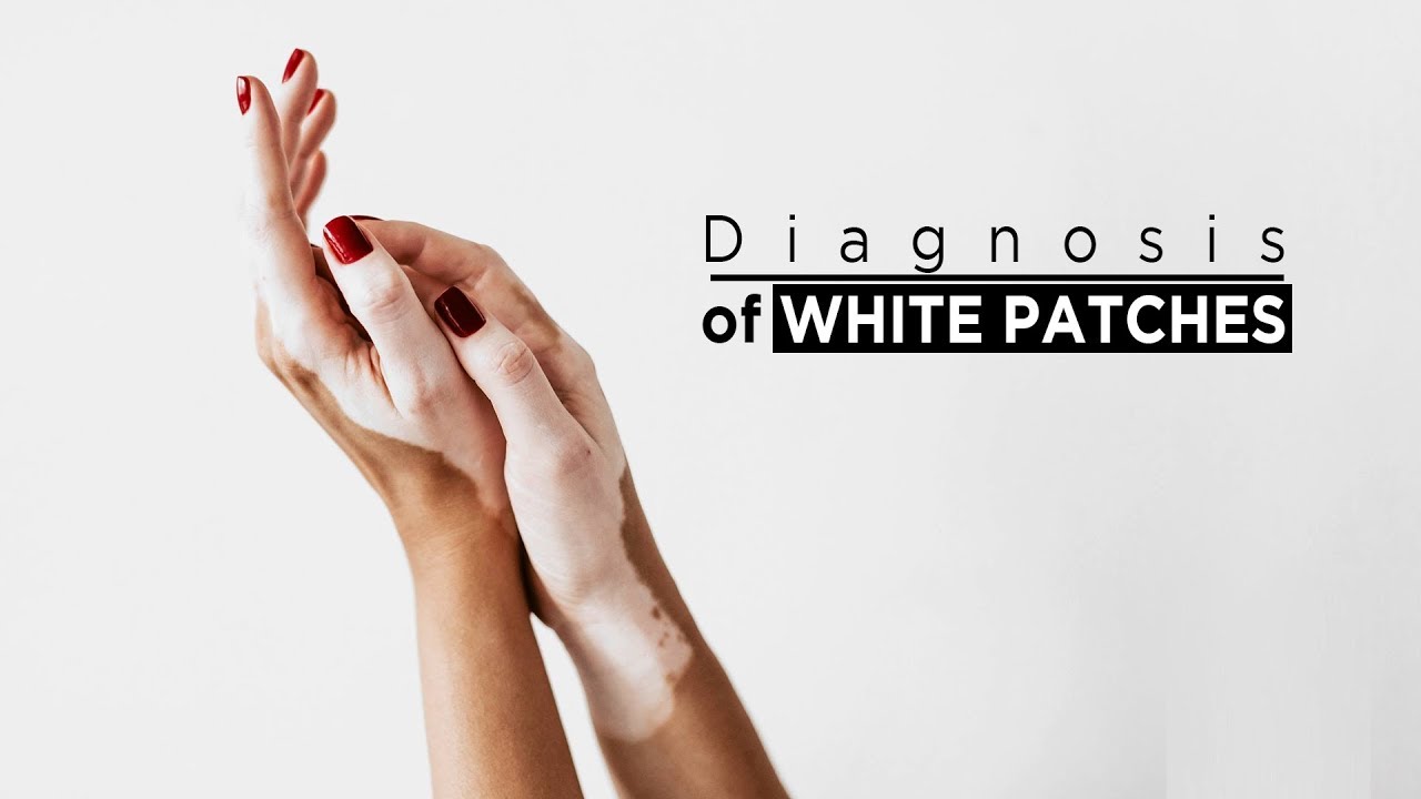 Diagnosis of White Patches || Aimil Healthcare || Dr. Nitika Kohli ...
