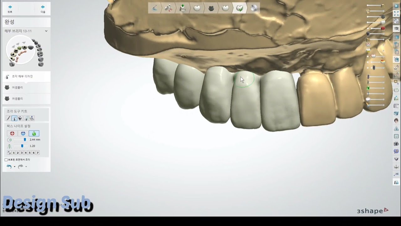 3shape design (anterior teeth 😬 implant case osstem) 11 12 13 14 15 - YouTube