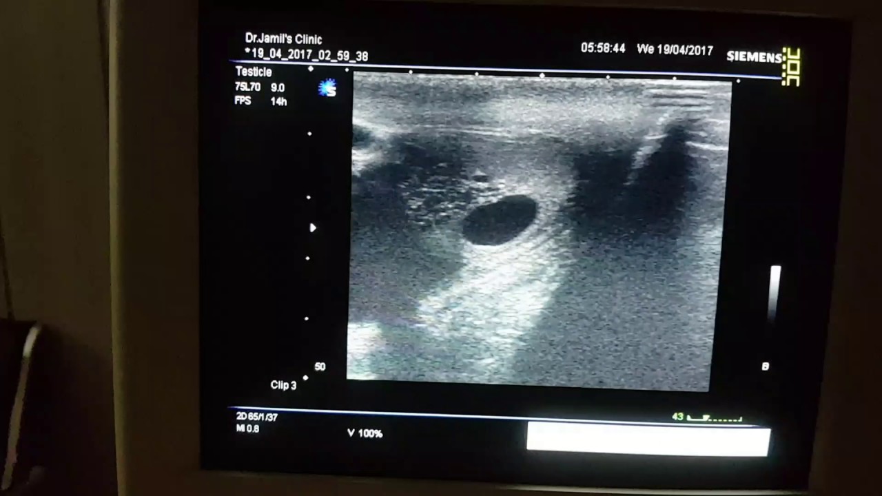Dilated Rete Testis Sonograohy Youtube