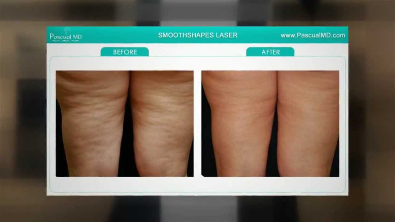 Miami SmoothShapes Laser Before and After Photos - YouTube