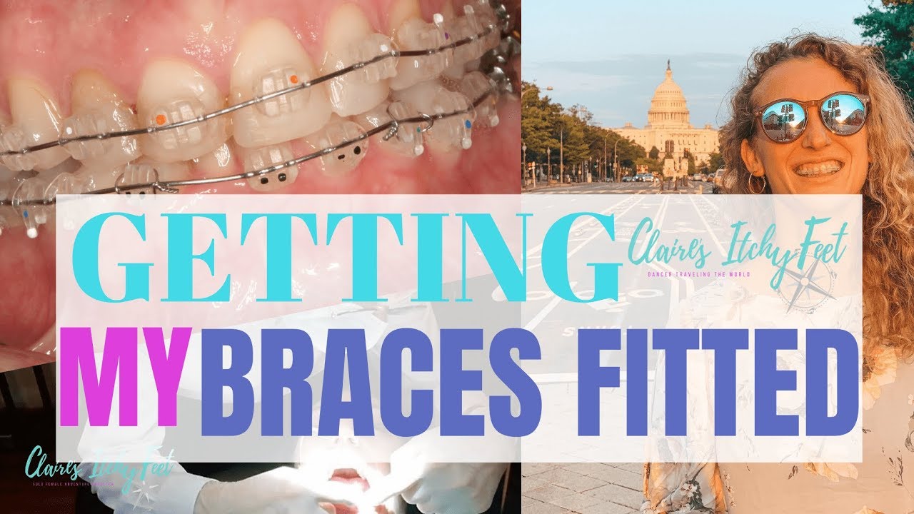Getting clear BRACES fitted the whole process from start to finish ...