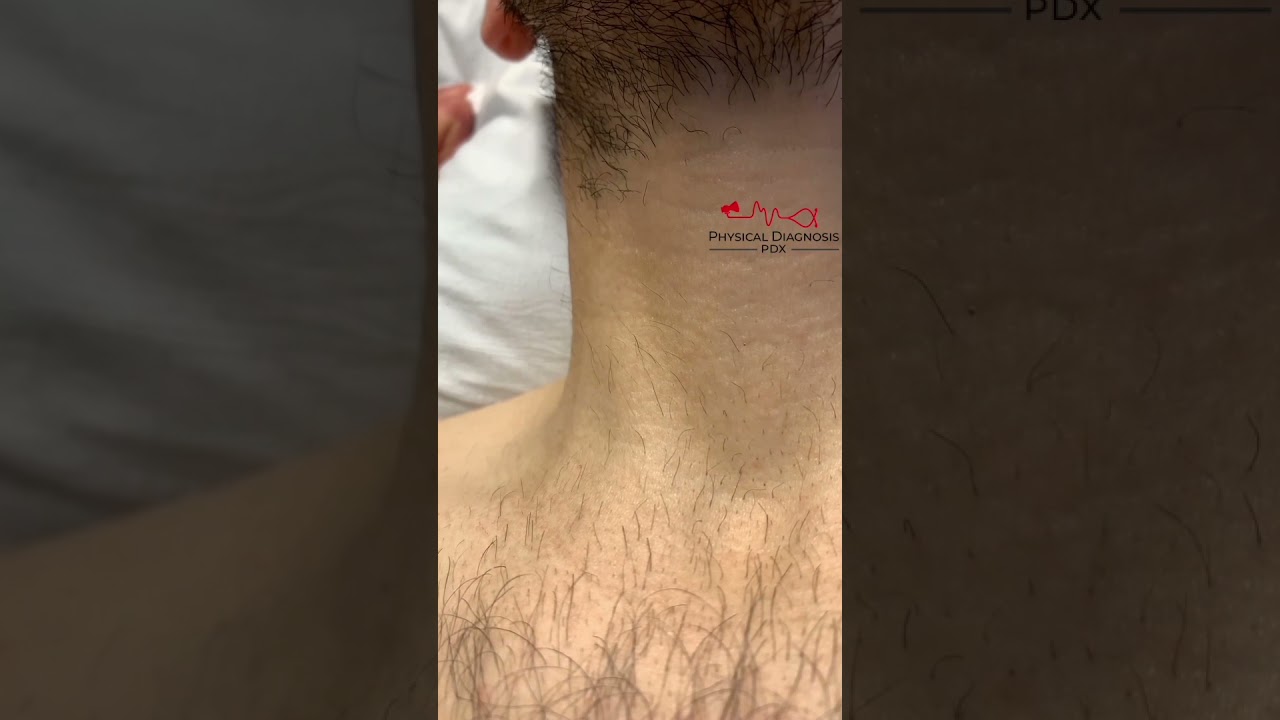 Lancisi's Sign (CV Fusion) of Severe Tricuspid Regurgitation - YouTube