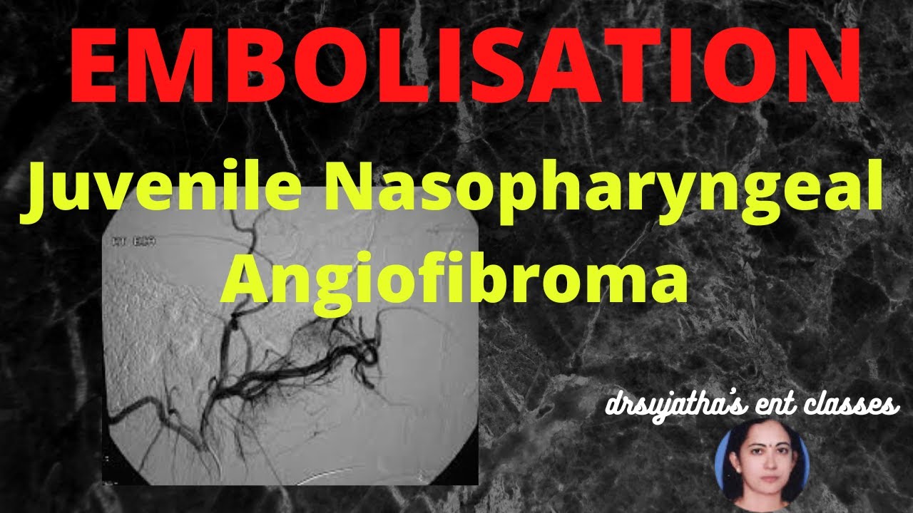 163.Juvenile Nasopharyngeal Angiofibroma -Part 6: Nonsurgical ...