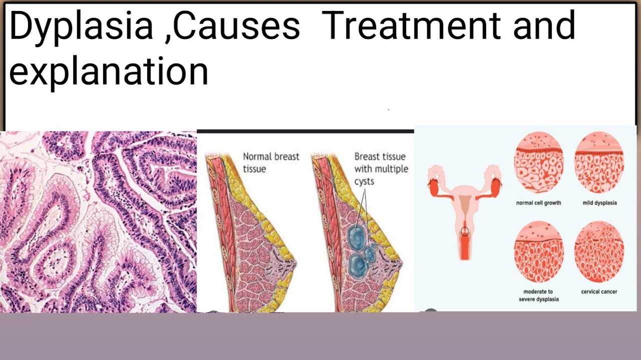 Dysplasia#it's causes#treatment#explaination#pathology - YouTube