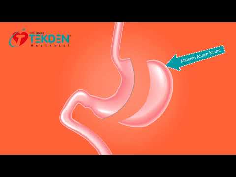 Tüp Mide Ameliyatı Nasıl Olur? (Animasyon Anlatım)