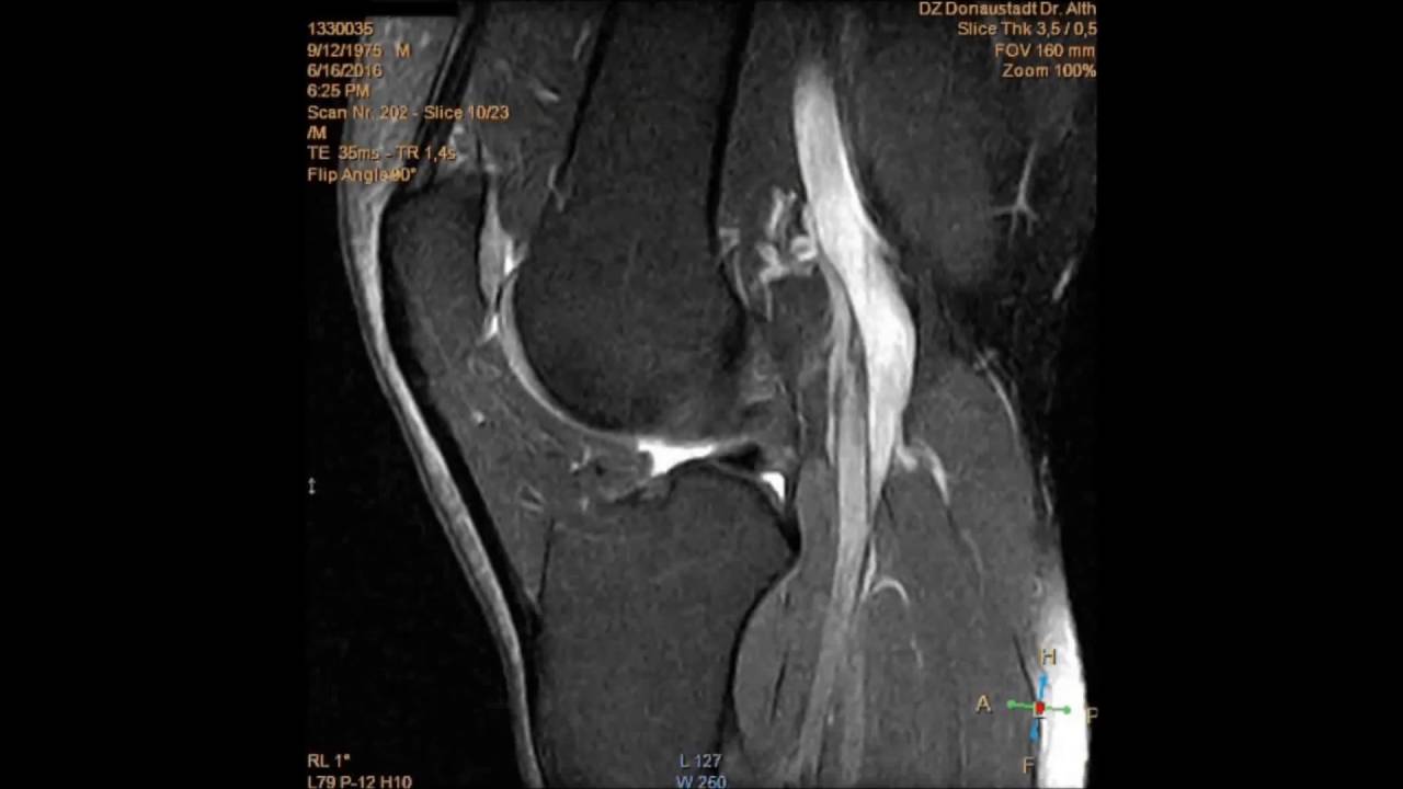 MRT (Magnetic Resonance Tomography) - left knee (MRI/IRM) - YouTube