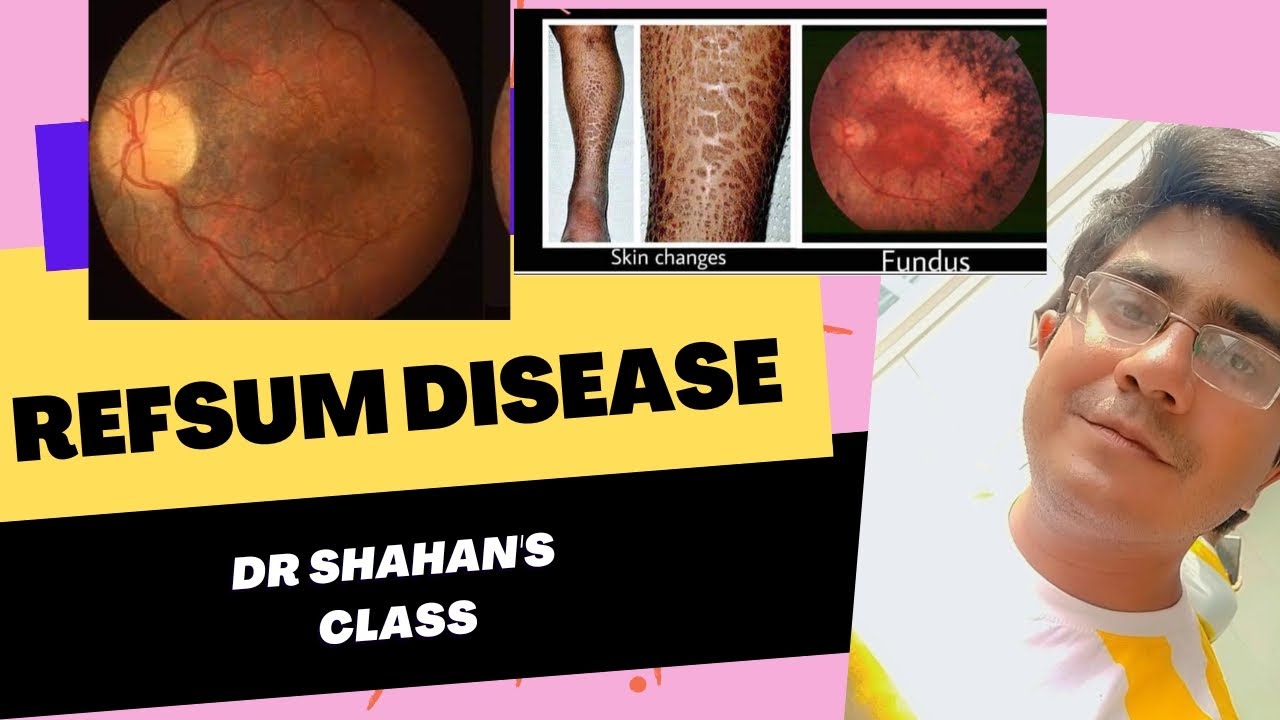 Refsum Disease | Retinitis Pigmentosa , Anosmia , Neuropathy - YouTube