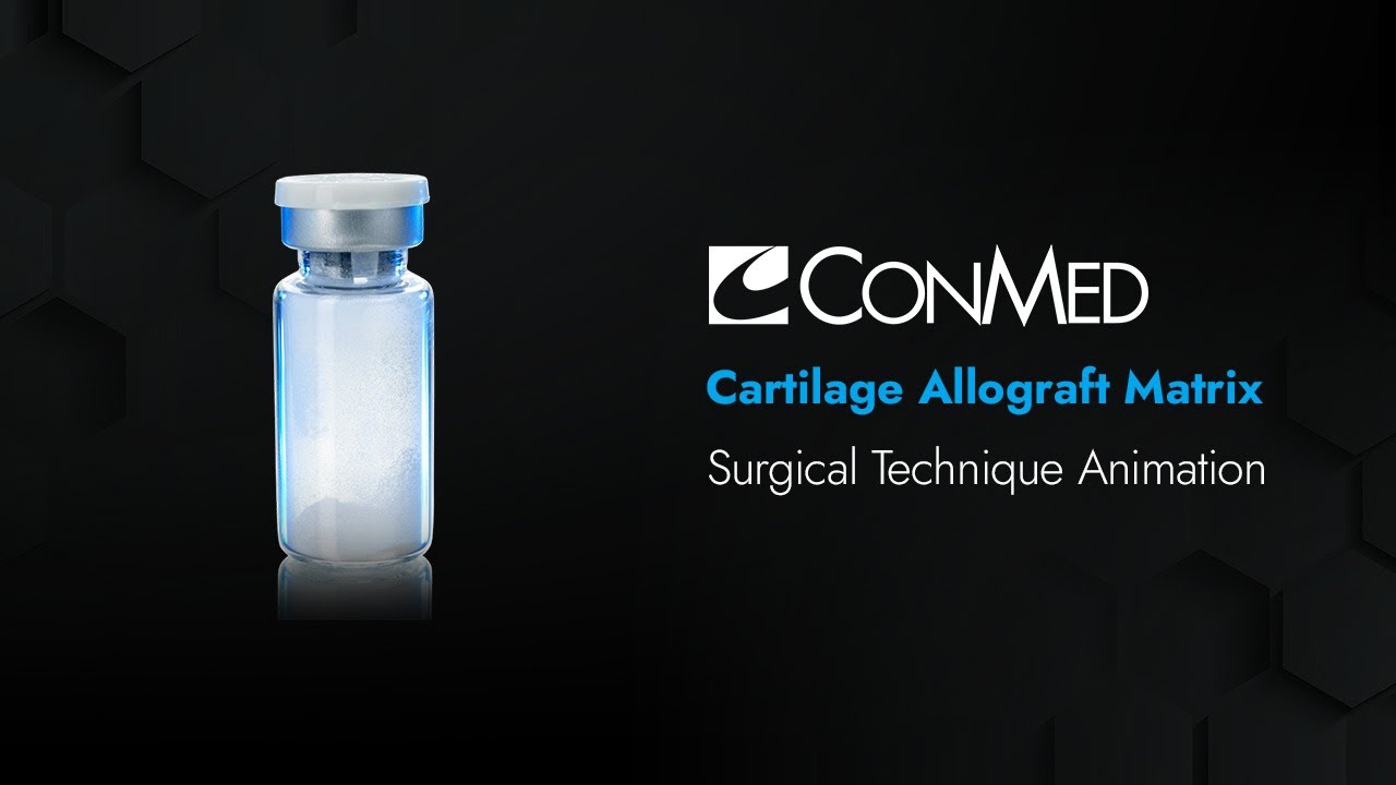 Cartilage Allograft Matrix - CONMED Animation - YouTube