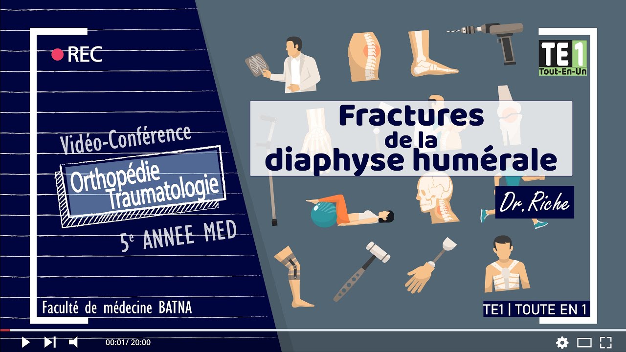 05 | Fractures de la diaphyse humérale - YouTube