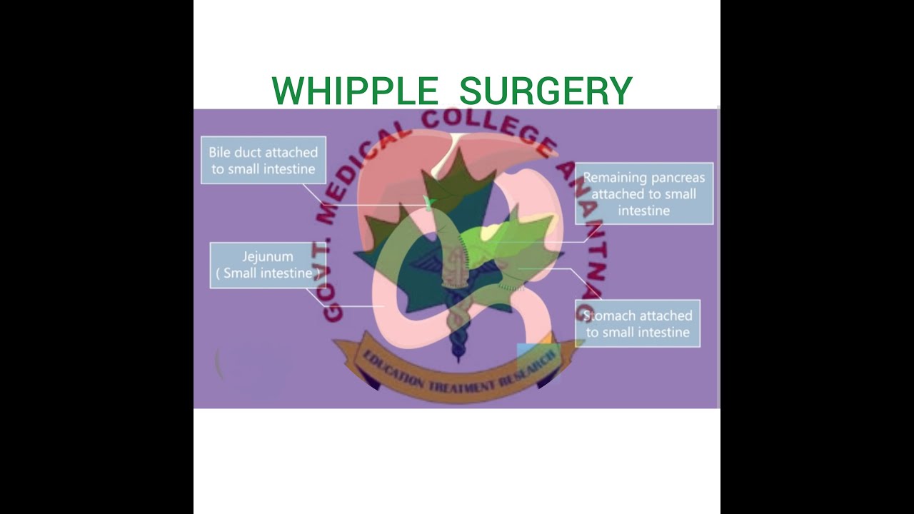 First Whipple surgery performed successfully at GMC Anantnag# ...